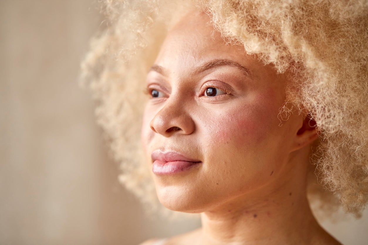 Climate Change, Albinism and Health: An Urgent Call to the Global ...